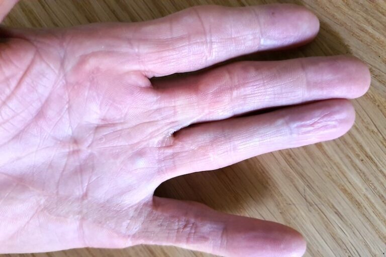 Opération de Dupuytren - Aponévrectomie, arthrolyse, ténolyse et greffe ...